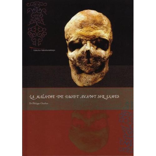 La Maladie De Paget Avant Sir James - Santé, Médecine | Rakuten